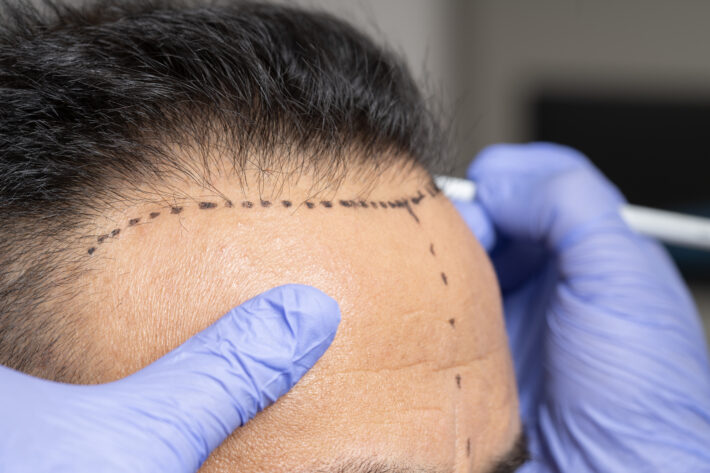 Hair Transplantation – ViennaHair
